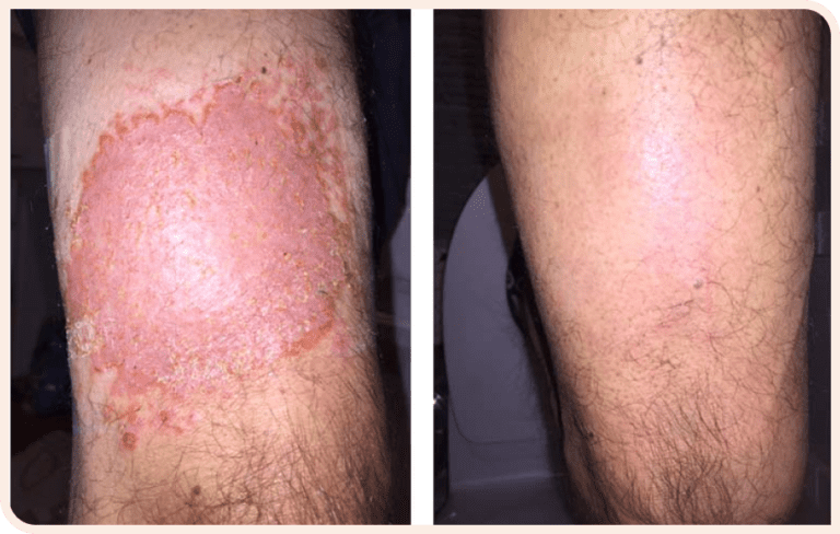 Expert Skin Infections Treatment in Pune | Skinsure