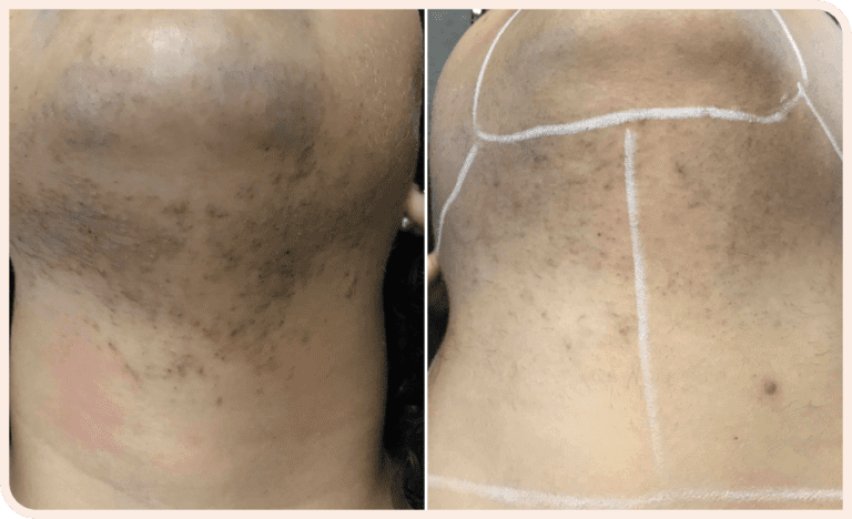 PCOS and Skin Treatment at Skinsure | Radiant Solution